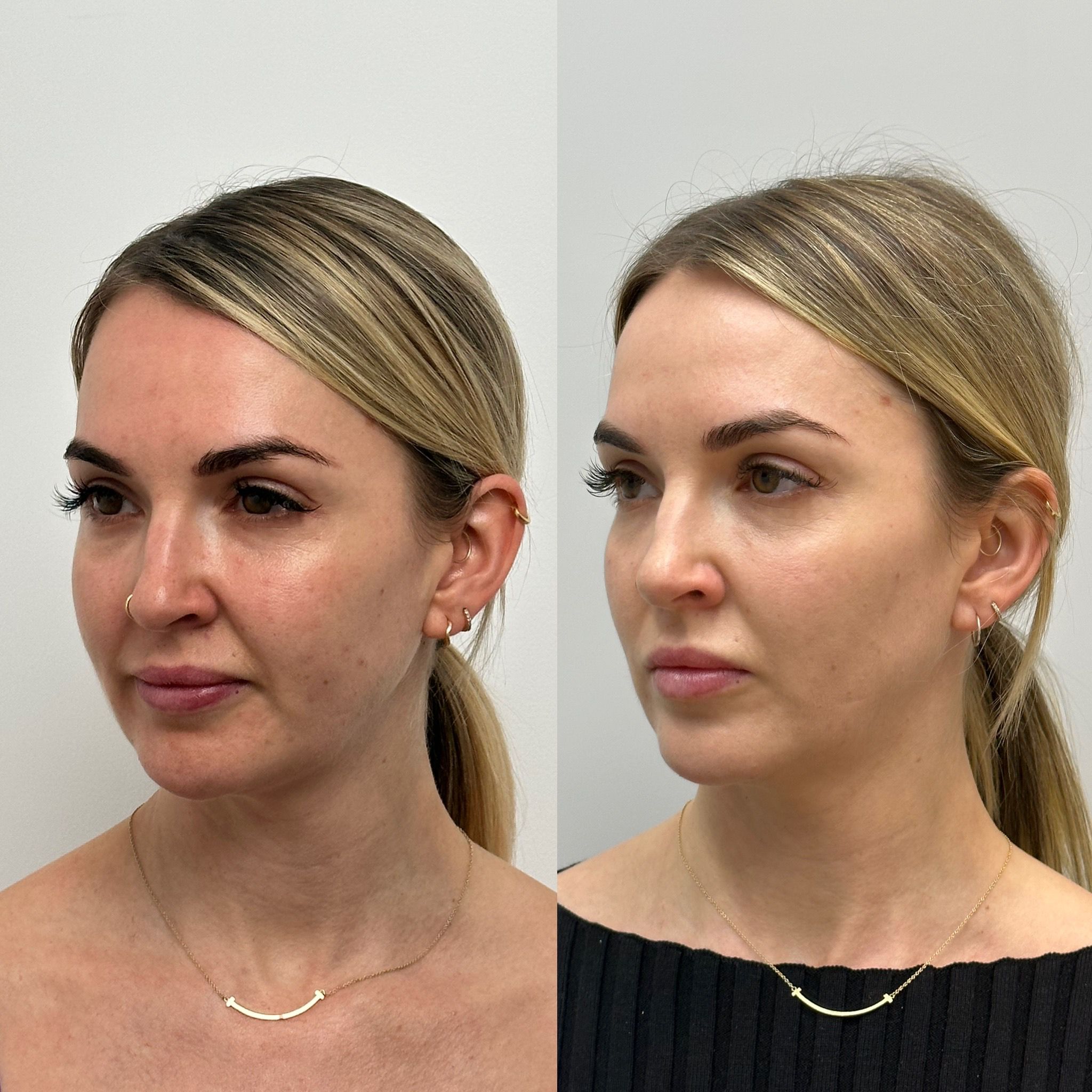 EMFACE: Less Wrinkles. More Lift. Needle-Free. – Millennium Magazine